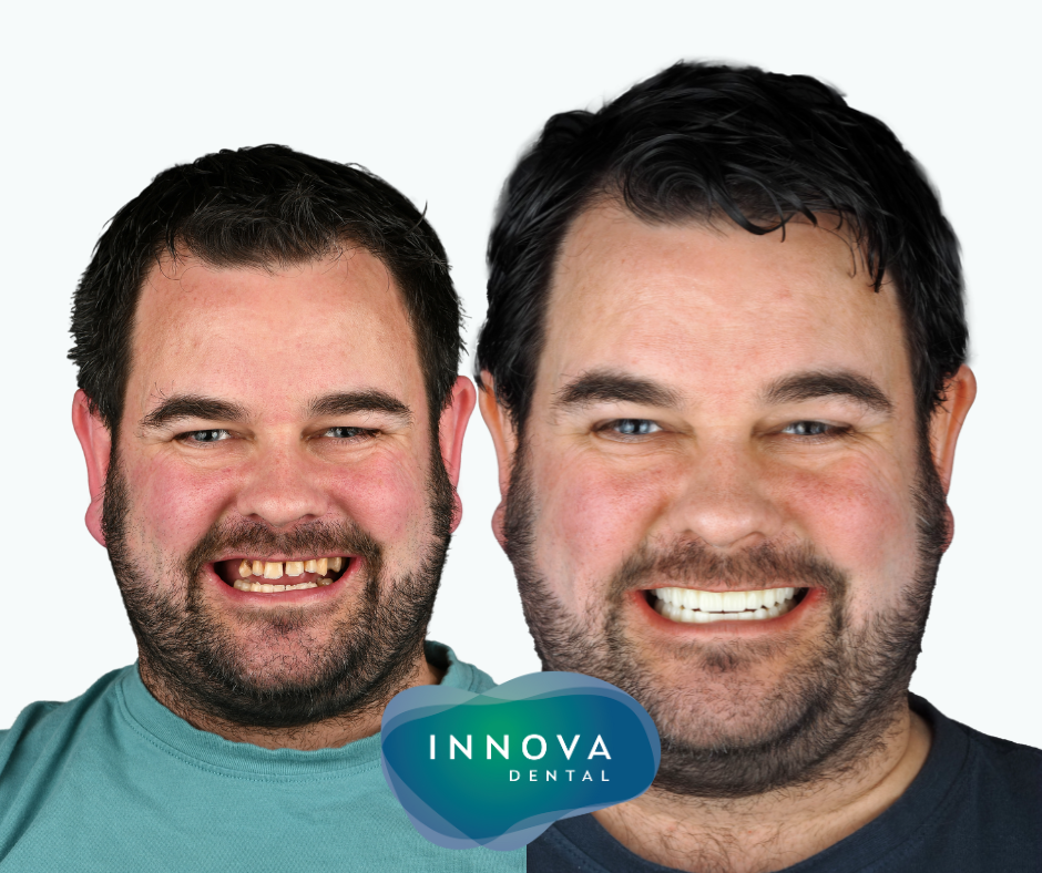 Best Places to Get Dental Implants in Australia | Innova Dental