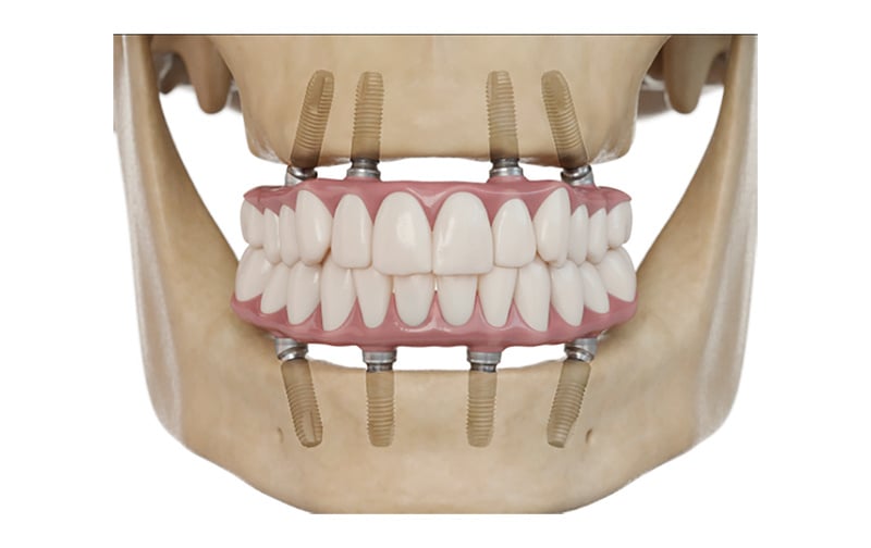 Full Arch Dental Implants and Dentures: The Viable Solution?